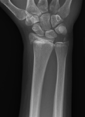 Endochondral Bone Formation - Basic Science - Orthobullets